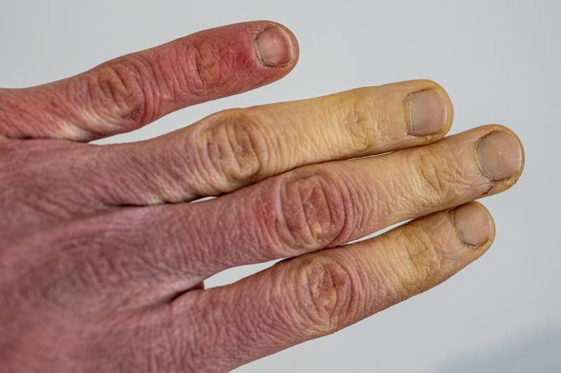 Syndrome de Raynaud : symptômes, causes et traitements | Charles.co