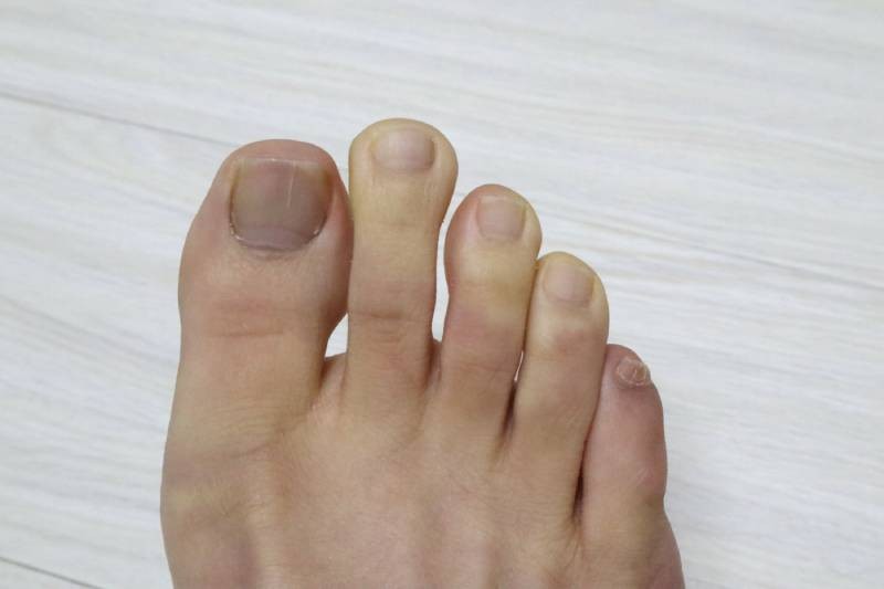 Maladie de Raynaud : traitements et solutions naturelles | Charles.co