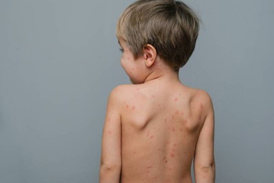 Bouton varicelle : causes, évolution, traitements et prévention ...