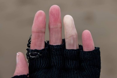 Maladie de Raynaud : traitements et solutions naturelles | Charles.co