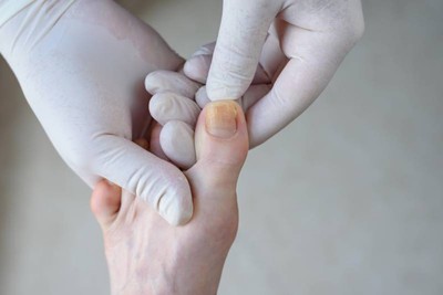 Mycose pied : symptômes, traitements médicaux et naturels | Charles.co