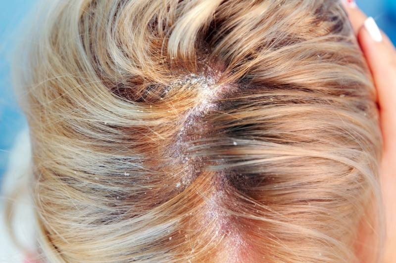 Psoriasis cheveux : traitement, cuir chevelu et perte de cheveux ...