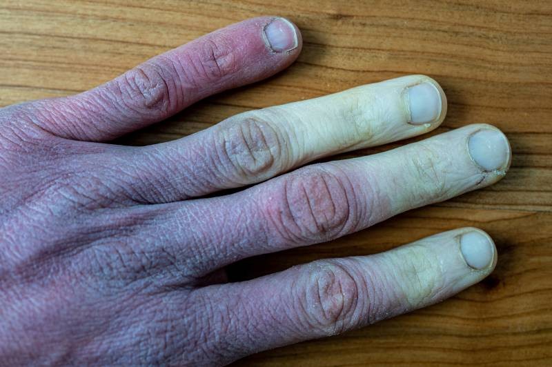 Maladie de Raynaud : traitements et solutions naturelles | Charles.co