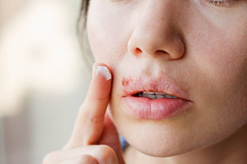 Herpès labial : symptômes, causes et traitements des boutons de fièvre ...