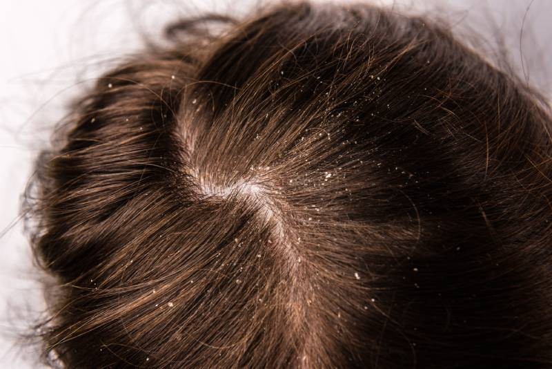Psoriasis : symptômes et traitements | Charles.co