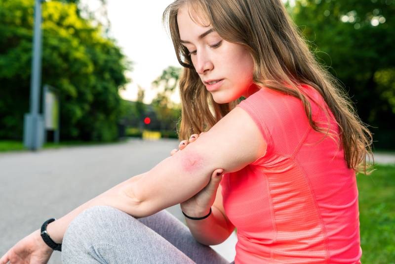 Piqûre d’araignée : symptômes, allergie et traitements | Charles.co