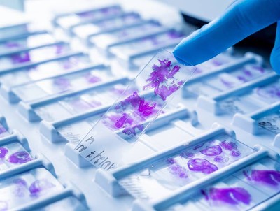 Biopsie : indications, techniques et interprétations des résultats ...