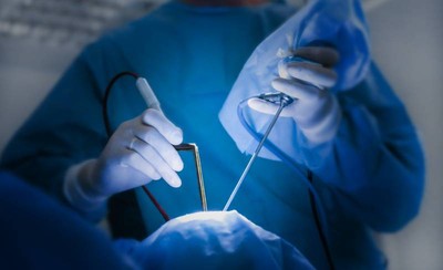 Polype : définition, causes, symptômes et traitements | Charles.co