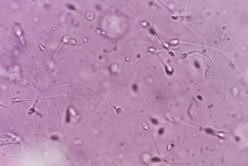 Azoospermie : causes et traitements de l'absence totale de spermatozoïdes dans le sperme ...