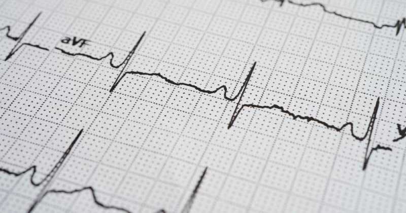 Arythmie cardiaque : symptômes, causes et traitements | Charles.co