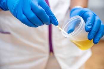 Urine foncée : faut-il s’inquiéter ? Quelles en sont les causes ...