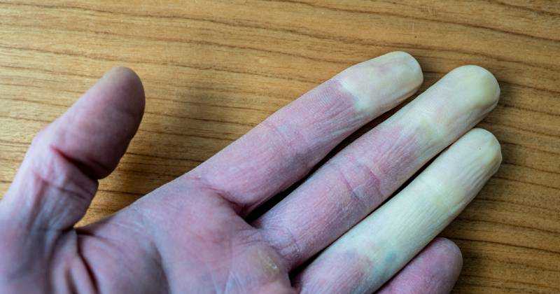 Syndrome de Raynaud : symptômes, causes et traitements | Charles.co