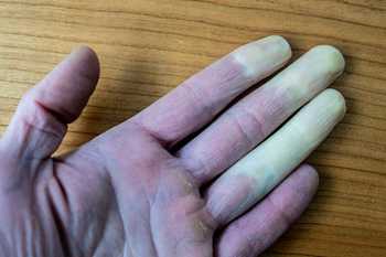 Syndrome de Raynaud : symptômes, causes et traitements | Charles.co