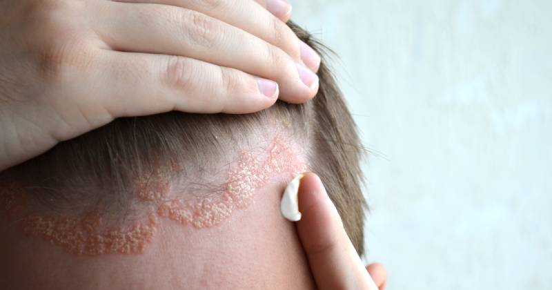 Dermoval : indications, effets et comment l’acheter | Charles.co