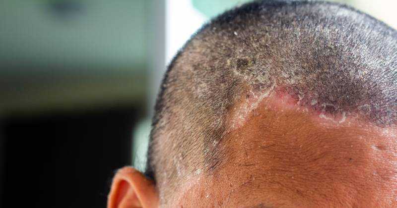 Locapred : utilisation, équivalents et comment l’acheter | Charles.co