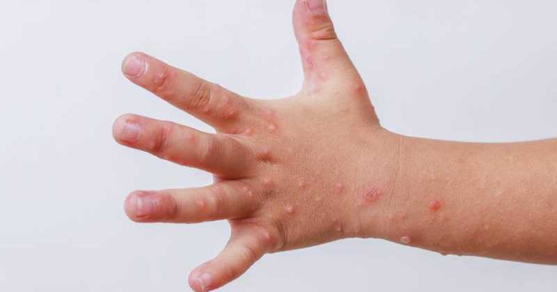 Scarlatine : symptômes, contagiosité et traitements | Charles.co