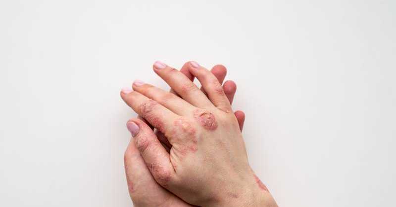 Quels sont les traitements efficaces contre le psoriasis ? Naturel et ...