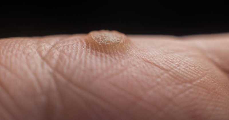 Verrue : symptômes, causes, types de verrues et traitements | Charles.co