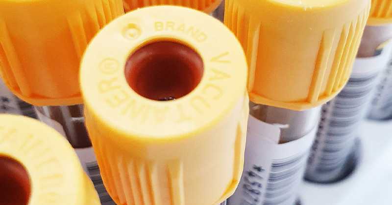 Sérologie TPHA VDRL : dépistage de la syphilis | Charles.co