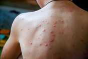 Bouton varicelle : causes, évolution, traitements et prévention ...