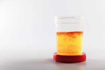 Infection urinaire sang : causes et traitements | Charles.co