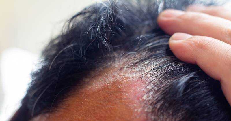 Psoriasis cuir chevelu : traitement, soin et remèdes naturels | Charles.co