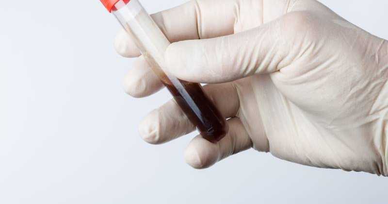 Transaminases : rôle, symptômes et que faire en cas de taux élevé ...